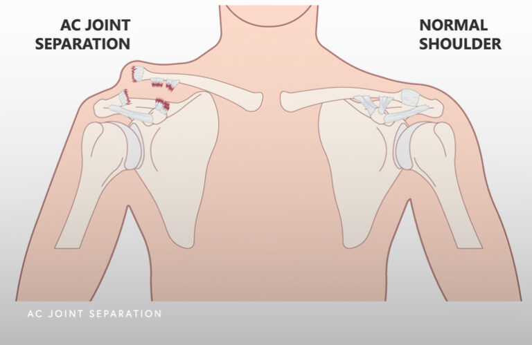 Ac Joint Conditions Schaumburg Thomas Obermeyer Md