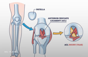 ACL Tear Schaumburg, IL - Thomas Obermeyer, MD