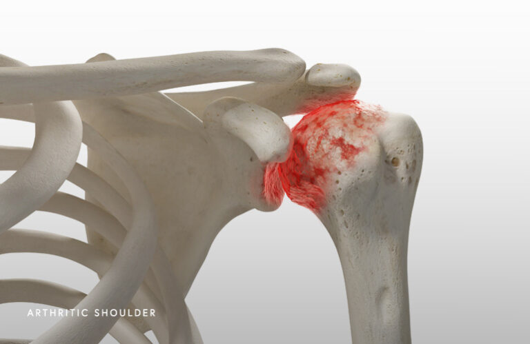 Severe Erosive Shoulder Arthritis Schaumburg - Thomas Obermeyer, MD