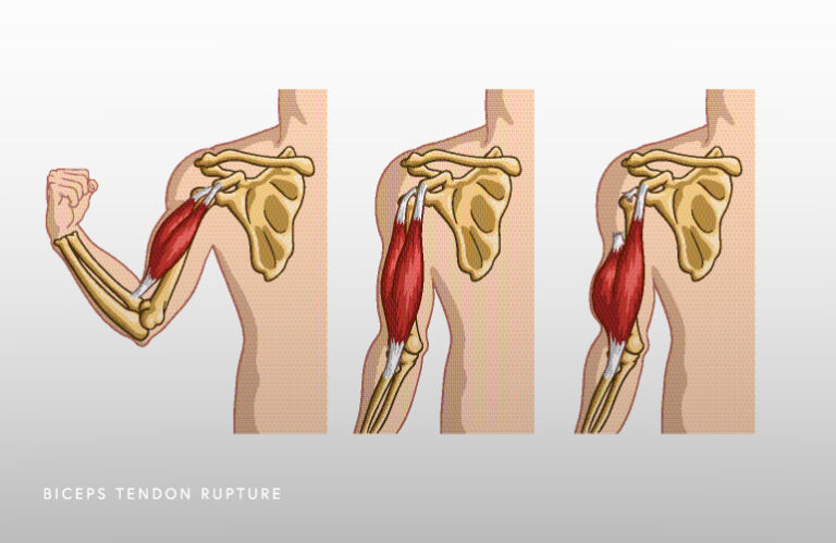 Biceps Tendon Injuries Schaumburg - Thomas Obermeyer, MD