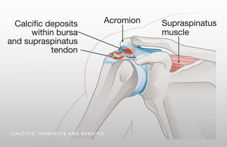 Calcific Tendonitis Schaumburg - Thomas Obermeyer, MD