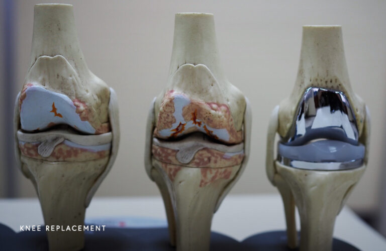 Knee Athritis Schaumburg Il Thomas Obermeyer Md