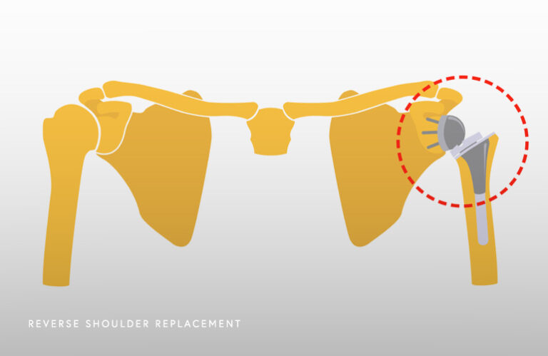 Rotator Cuff Arthropathy Schaumburg - Thomas Obermeyer, MD