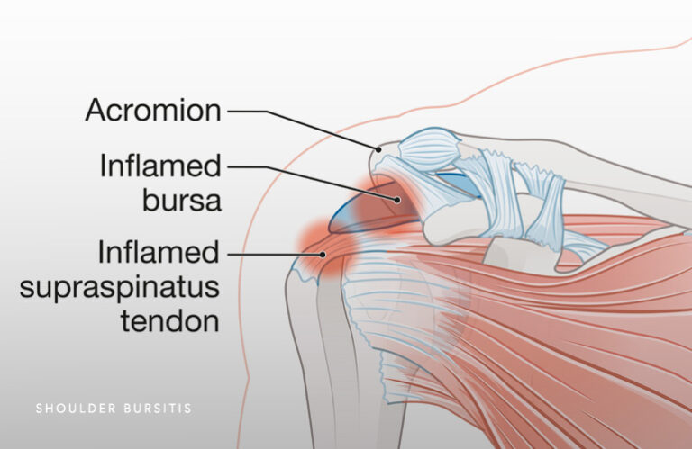 Shoulder Bursitis Schaumburg Thomas Obermeyer Md