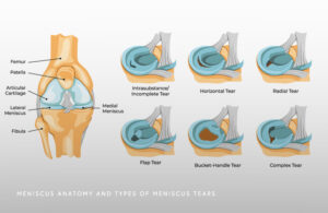 Meniscus Tear Schaumburg - Thomas Obermeyer, MD