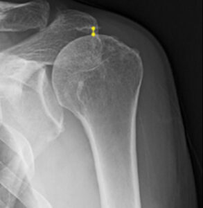 Reverse Total Shoulder Replacement Schaumburg - Thomas Obermeyer, MD