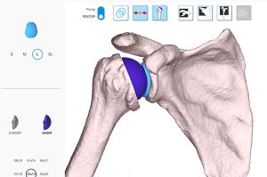 Total Shoulder Replacement Schaumburg - Thomas Obermeyer, MD